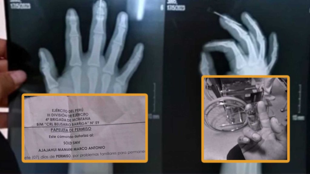 Médicos amputaron dedo de un soldado por inoportuna asistencia médica ...